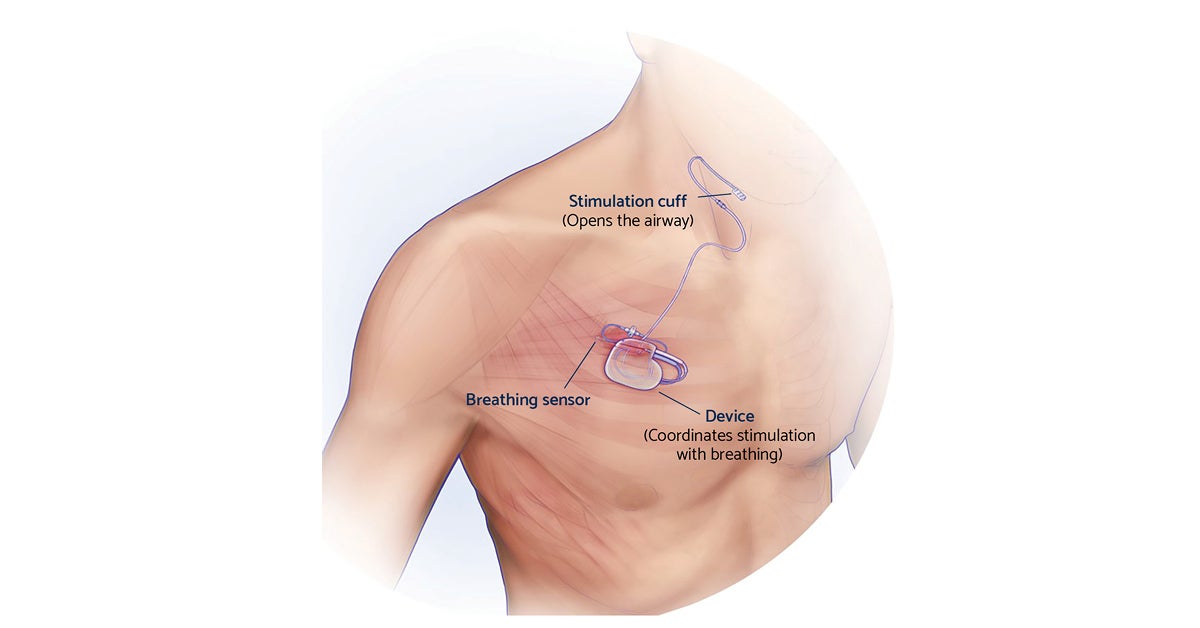 Inspire Therapy Now Offered for CPAP-Intolerant Sleep Apnea